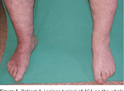 Figure 4 from Acrodermatitis chronica atrophicans: various faces of the ...