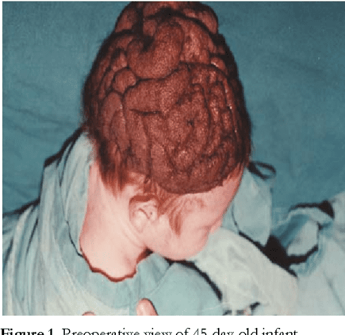 [PDF] Aesthetic Reconstruction of Congenital Cerebriform Intradermal ...
