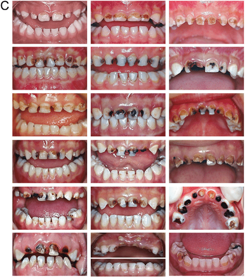 Figure 1 from A Proposed Definition − Hypoplasia-associated Severe Early Childhood Caries ...