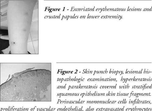 Figure 1 from Prurigo simplex subacuta or prurigo simplex acuta ...