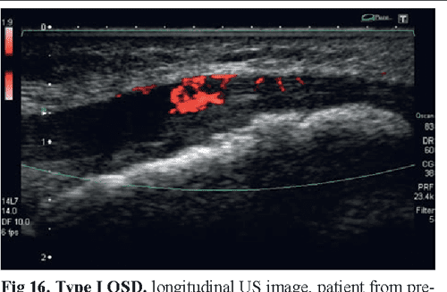 Osgood-Schlatter disease in ultrasound diagnostics--a pictorial essay ...