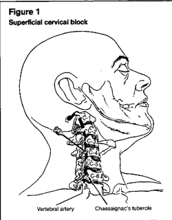 Figure 1 from Superficial and deep cervical plexus block: technical ...