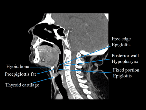 Figure 10 from Hypopharynx and larynx anatomy | Semantic Scholar