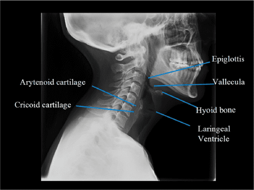Hypopharynx and larynx anatomy | Semantic Scholar