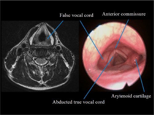 Hypopharynx and larynx anatomy | Semantic Scholar