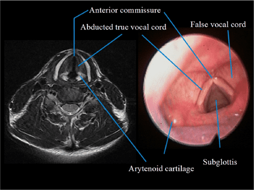 Figure 2 from Hypopharynx and larynx anatomy | Semantic Scholar
