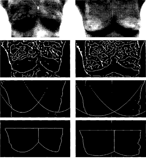 Figure 3 from Asymmetry analysis using automatic segmentation and ...