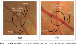 An effective automated system for grading severity of retinal ...