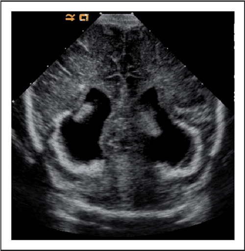 Diffuse periventricular calcification and brain atrophy: A case of ...