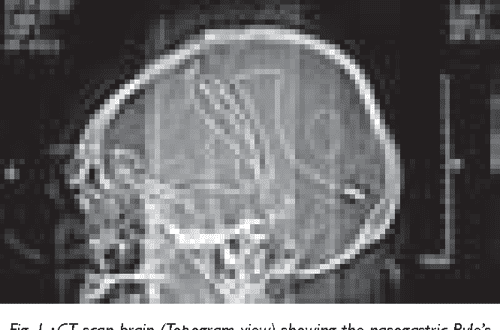 Figure 1 from Inadvertent insertion of nasogastric tube into the brain ...