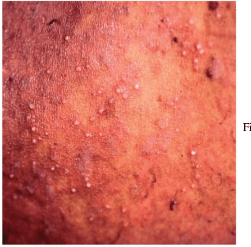 Le psoriasis : physiopathologie, traitements et conseils à l’officine ...