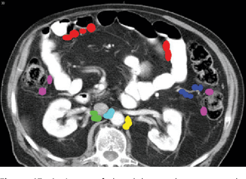 Learning the nodal stations in the abdomen. | Semantic Scholar