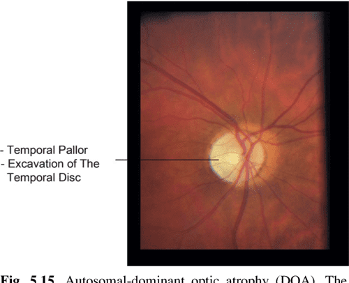 Figure 5.3 from Abnormalities of the optic disc. | Semantic Scholar