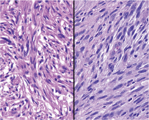 Figure 1 from Laryngeal Spindle Cell Squamous Cell Carcinoma | Semantic ...