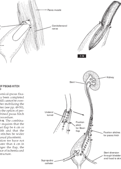 Figure 7-11 from PSOAS HITCH , BOARI FLAP , AND COMBINATION OF PSOAS ...