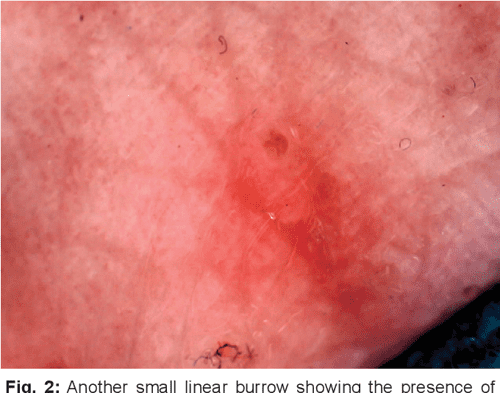 Figure 2 from Dermoscopy in the Diagnosis of Scabies | Semantic Scholar