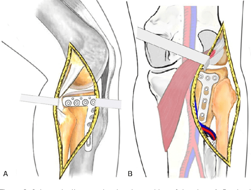 Figure 3 From Treatment Of Posterolateral Tibial Plateau Fractures With