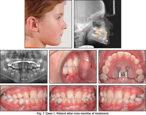 Figure 9 from Early Class III treatment with a hybrid hyrax-mentoplate ...