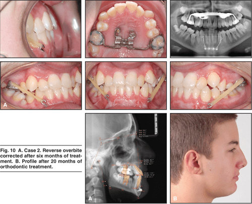 Figure 9 from Early Class III treatment with a hybrid hyrax-mentoplate ...