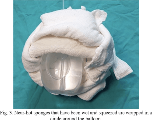 Figure 1 from Abdominal Packing for Obstetric Surgical Uncontrollable ...