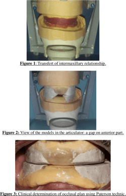Figure 1 from Determination of the Occlusal Plane in Complete Denture ...