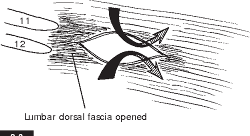Figure 2-14 from THE FLANK INCISION AND EXPOSURE OF THE KIDNEY 2 ...