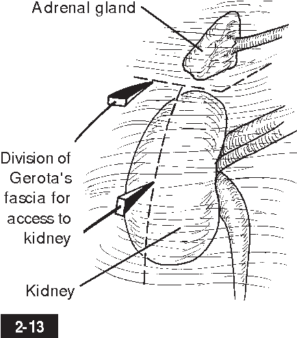Figure 2-14 from THE FLANK INCISION AND EXPOSURE OF THE KIDNEY 2 ...