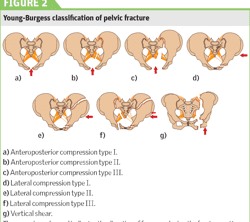 Pelvic fractures: classification and nursing management. | Semantic Scholar