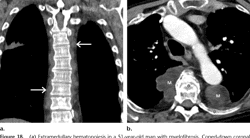 Figure 1 from ITMIG Classification of Mediastinal Compartments and ...