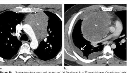 Figure 1 from ITMIG Classification of Mediastinal Compartments and ...