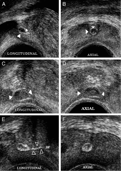 Figure 6 from Cystic lesions of the prostate gland: an ultrasound ...