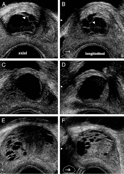 Cystic lesions of the prostate gland: an ultrasound classification with ...