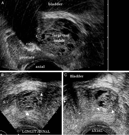 Figure 6 From Cystic Lesions Of The Prostate Gland An Ultrasound Classification With