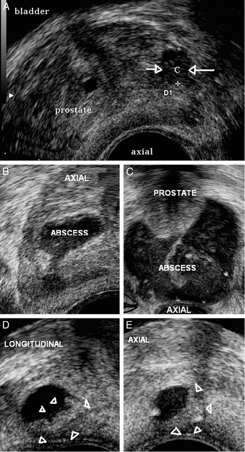 Figure 6 from Cystic lesions of the prostate gland: an ultrasound ...