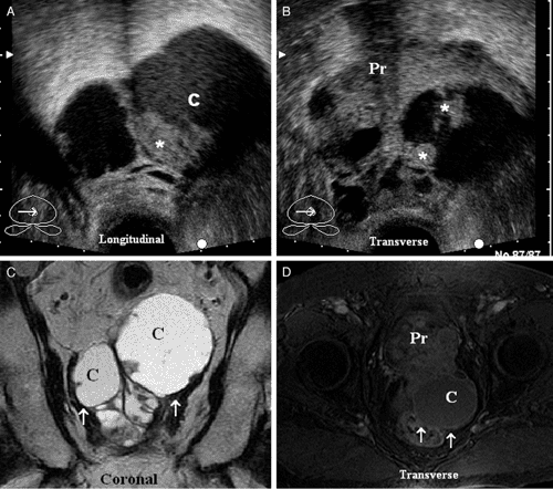 Cystic lesions of the prostate gland: an ultrasound classification with ...