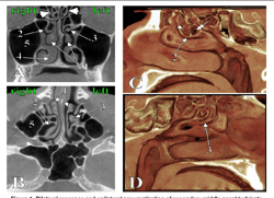 [PDF] Rare Anatomic Variation: Pneumatized Secondary Middle Turbinate ...