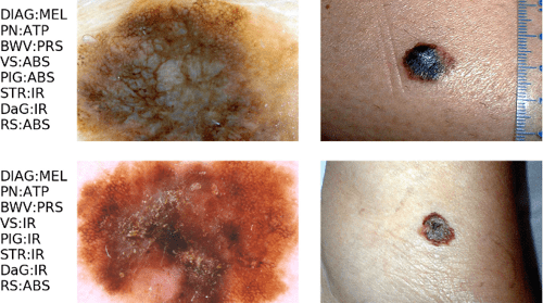 Figure 5 from Seven-Point Checklist and Skin Lesion Classification ...