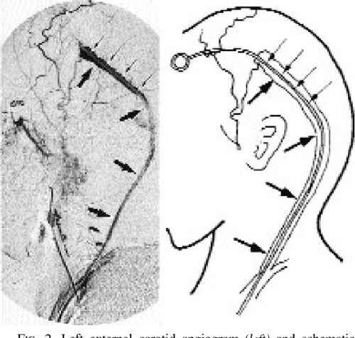 Figure 1 from Arteriovenous fistula around the ventriculoperitoneal ...