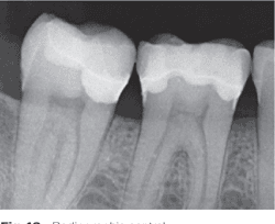 [PDF] Deep margin elevation versus crown lengthening: biologic width revisited. | Semantic Scholar