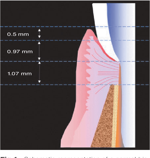 [PDF] Deep margin elevation versus crown lengthening: biologic width ...