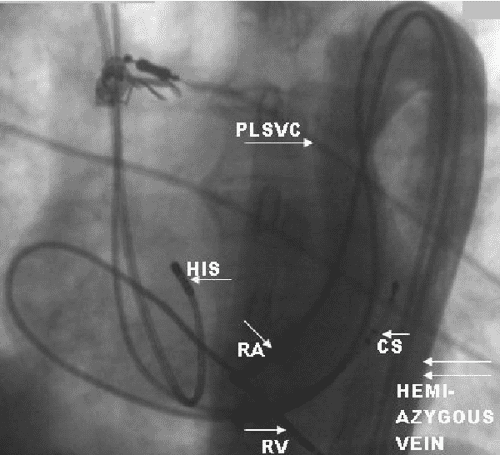 [PDF] Radiofrequency Catheter Ablation Of Atrioventricular Nodal ...