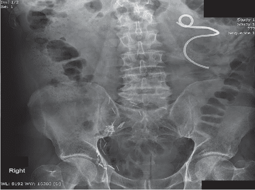 Figure 3 from Percutaneous Nephrolithotomy in a Patient with Mainz ...