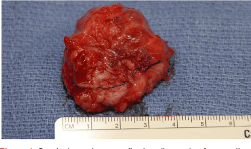 Acromioclavicular Joint Ganglion Radiology Case