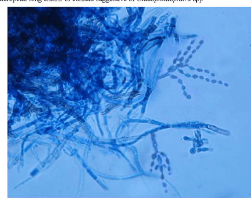 Figure 1 from Chromoblastomycosis caused by Cladophialophora carrionii ...
