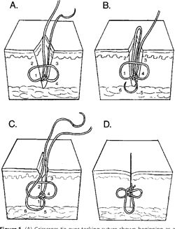 Figure 1 from The Crisscross Tie‐Over Tacking Suture Revisited ...