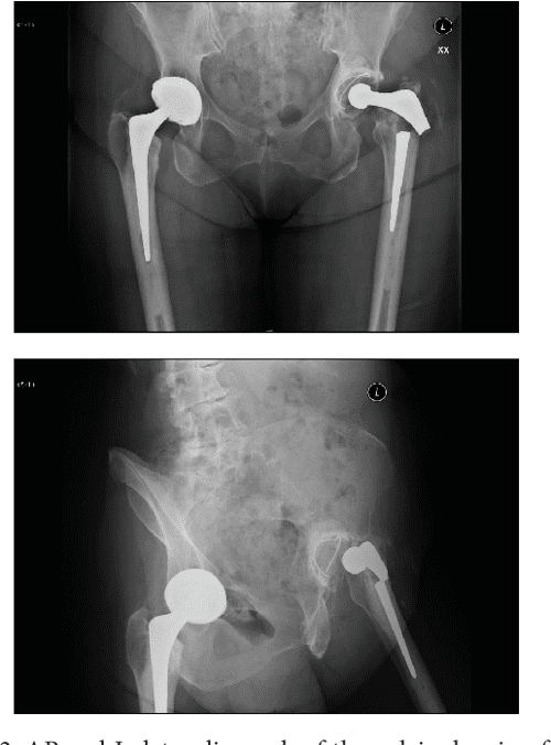 Figure 2 from A Dual Biomechanical Failure: Exeter Stem and Pubic Rami ...