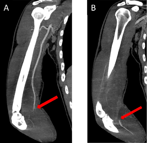 Figure 4 from Brachial artery thrombosis secondary to fixation screw ...