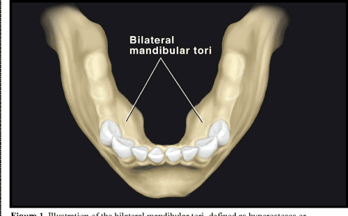[PDF] Mandibular tori as a source for onlay bone graft augmentation: a ...