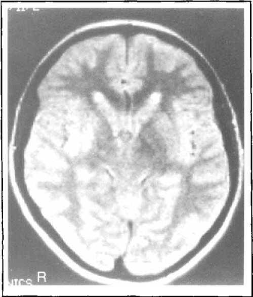 Figure 1 from MRI periventricular lesions in adults | Semantic Scholar