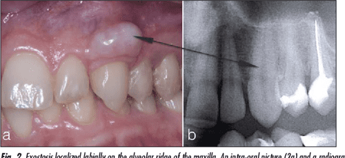 [PDF] Exostoses of jaw bones: aetiology, morphology and treatment of ...